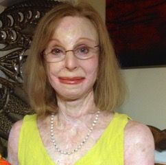 Hidden From View: Women With Facial Differences in the Media ...