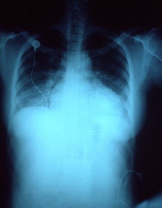 x ray heart problems