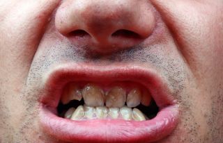 Severe Dental Disease in Substance Use Disorders | Psychology Today