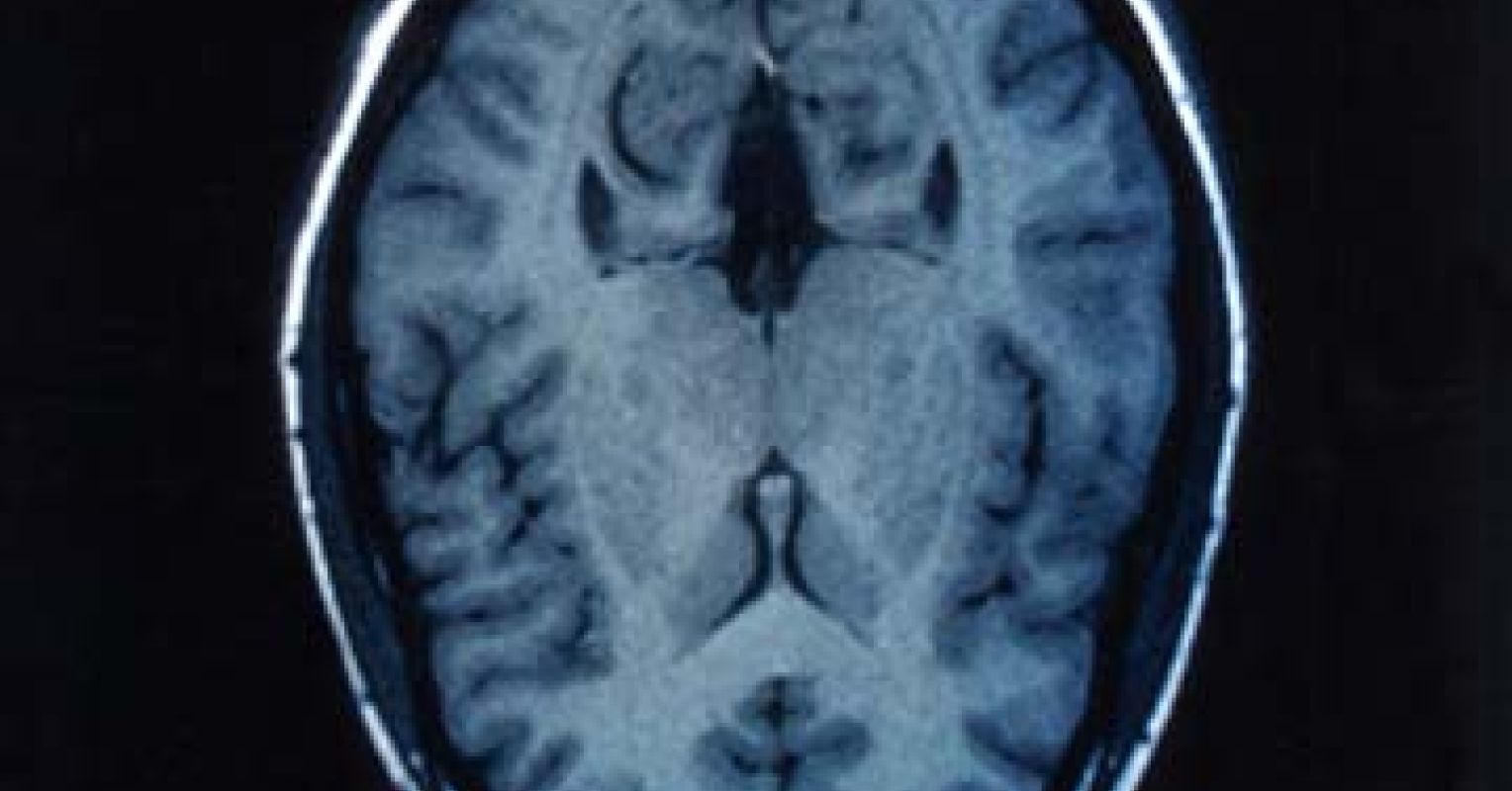 Brain Surgery for Obsessive-Compulsive Disorder: A Cautionary Note ...