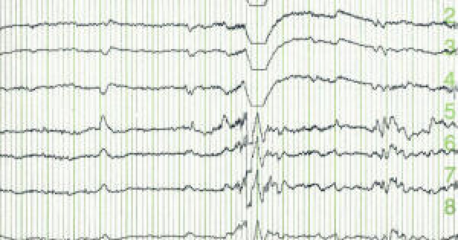 EEGs: Diagnosing Autism Risk in Infants | Psychology Today Canada