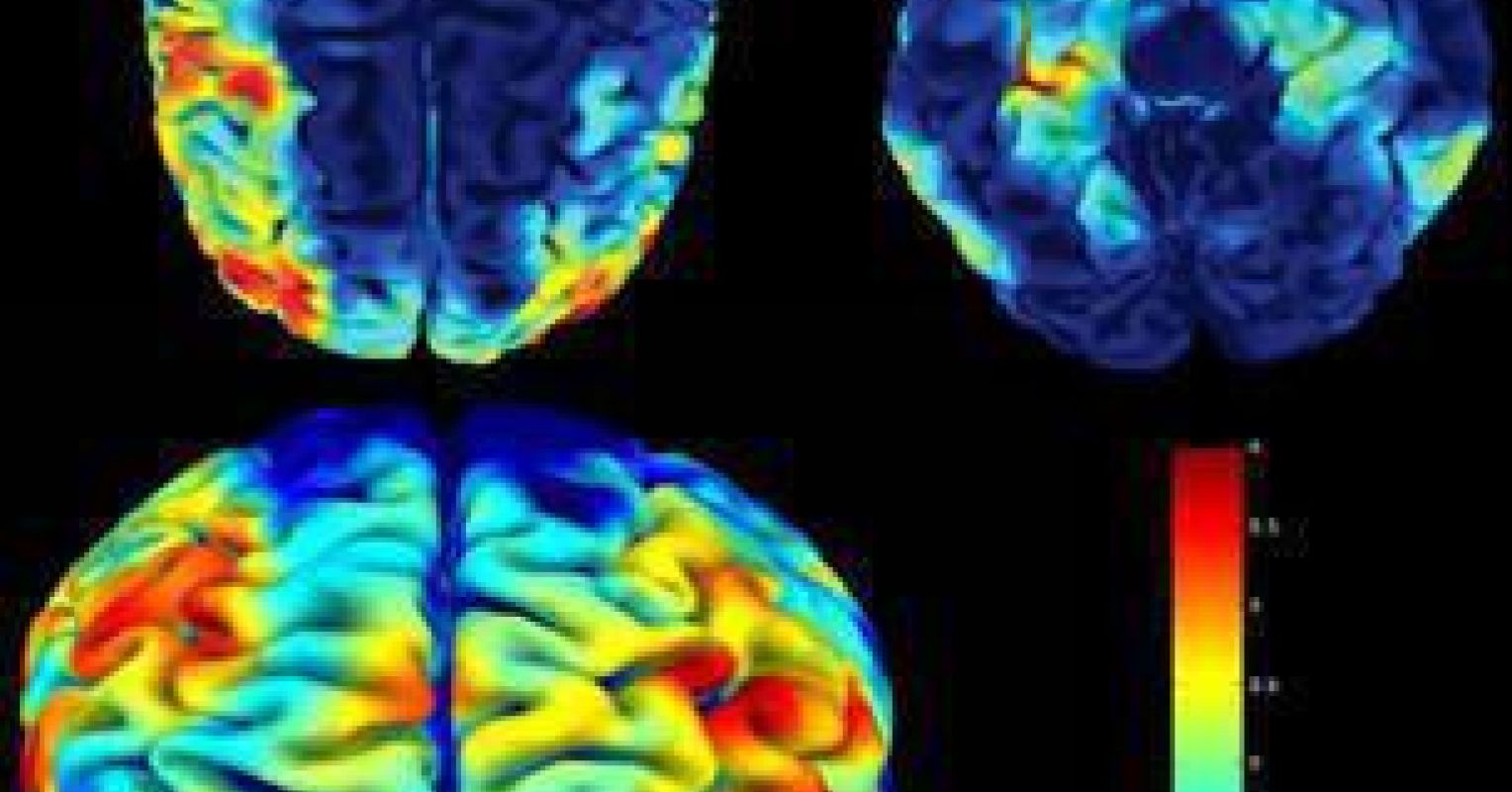 Medications, Therapy, Exercise in Treating Depression...All Remodel the ...