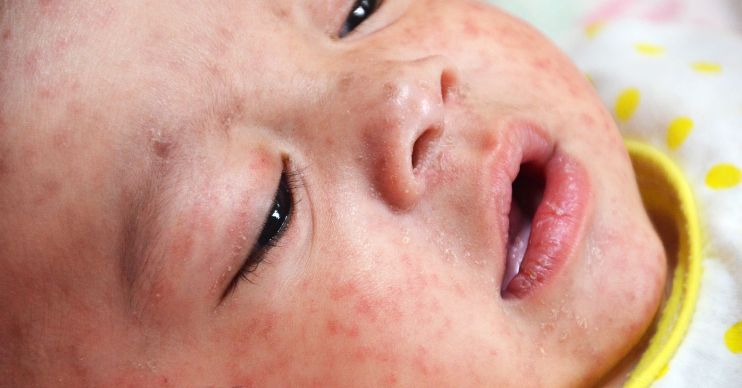 Does Measles Cause Brain Damage? Yes, Here’s How It Happens ...