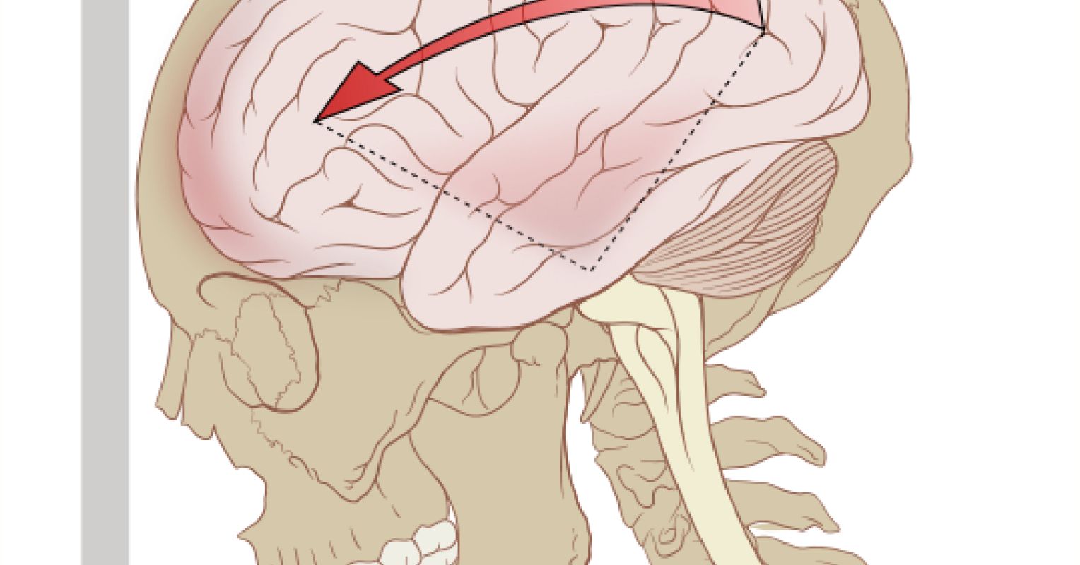 Understanding Traumatic Brain Injury | Psychology Today