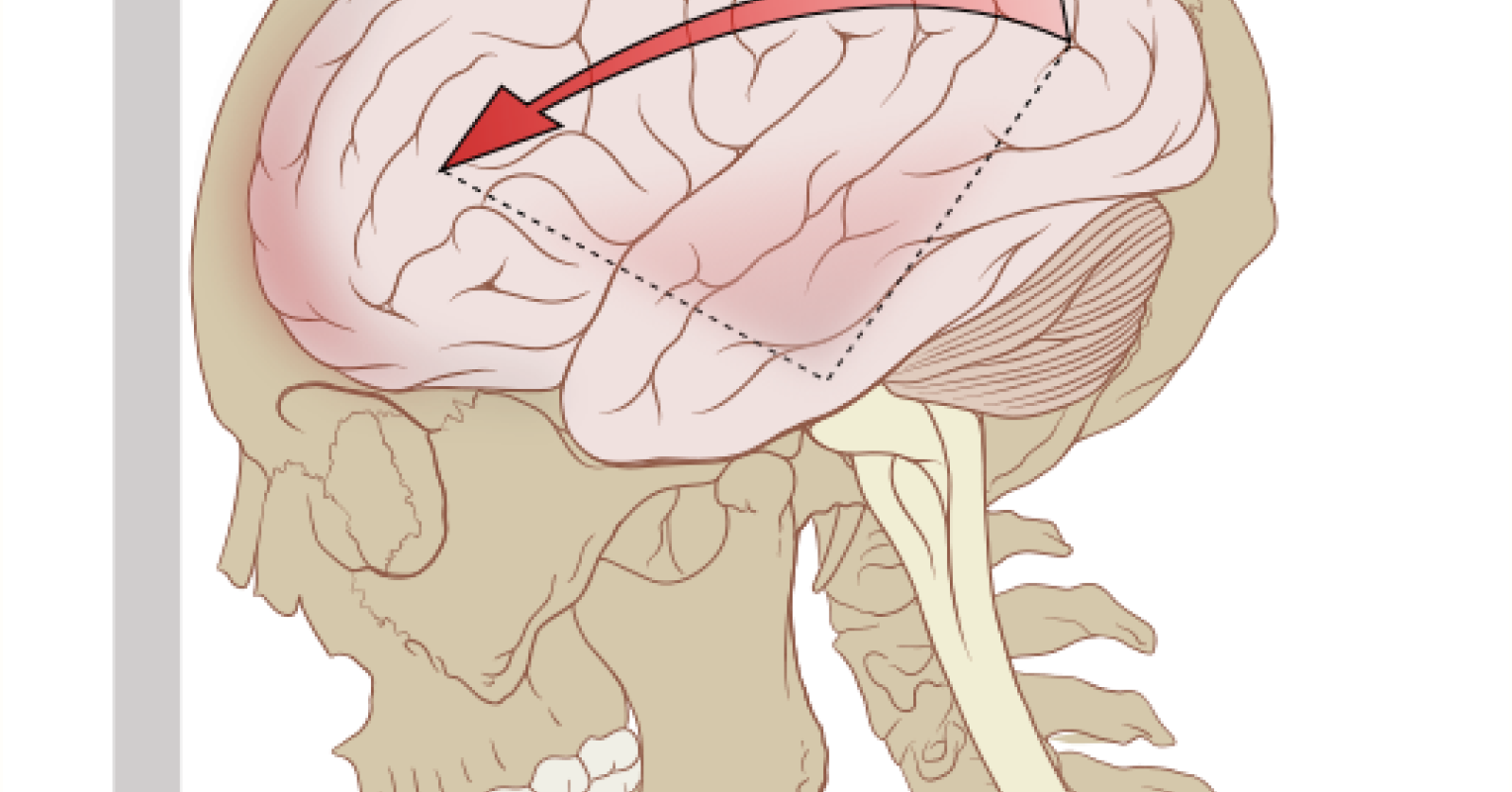 Understanding Traumatic Brain Injury | Psychology Today Australia