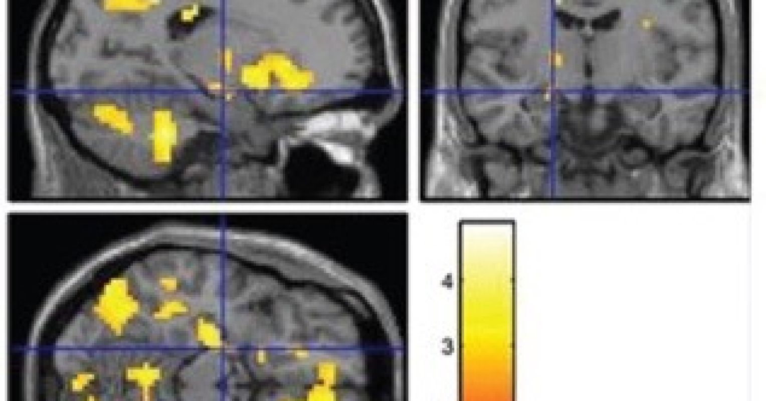 Autistic Brains Function Oppositely to Psychotic Ones | Psychology Today