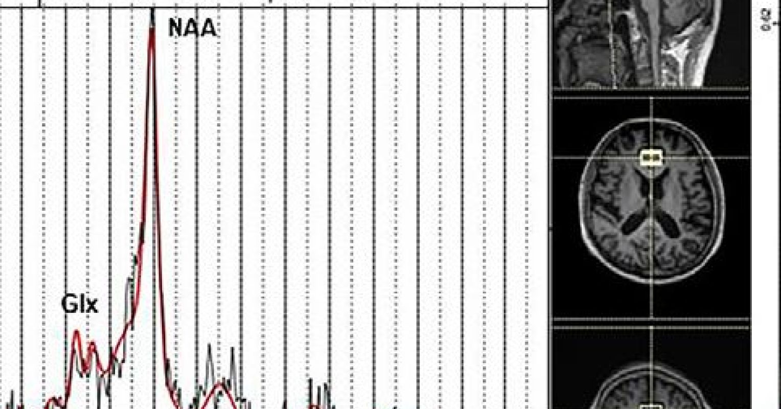 New Study Shows Brain Change After Psychological Trauma | Psychology Today