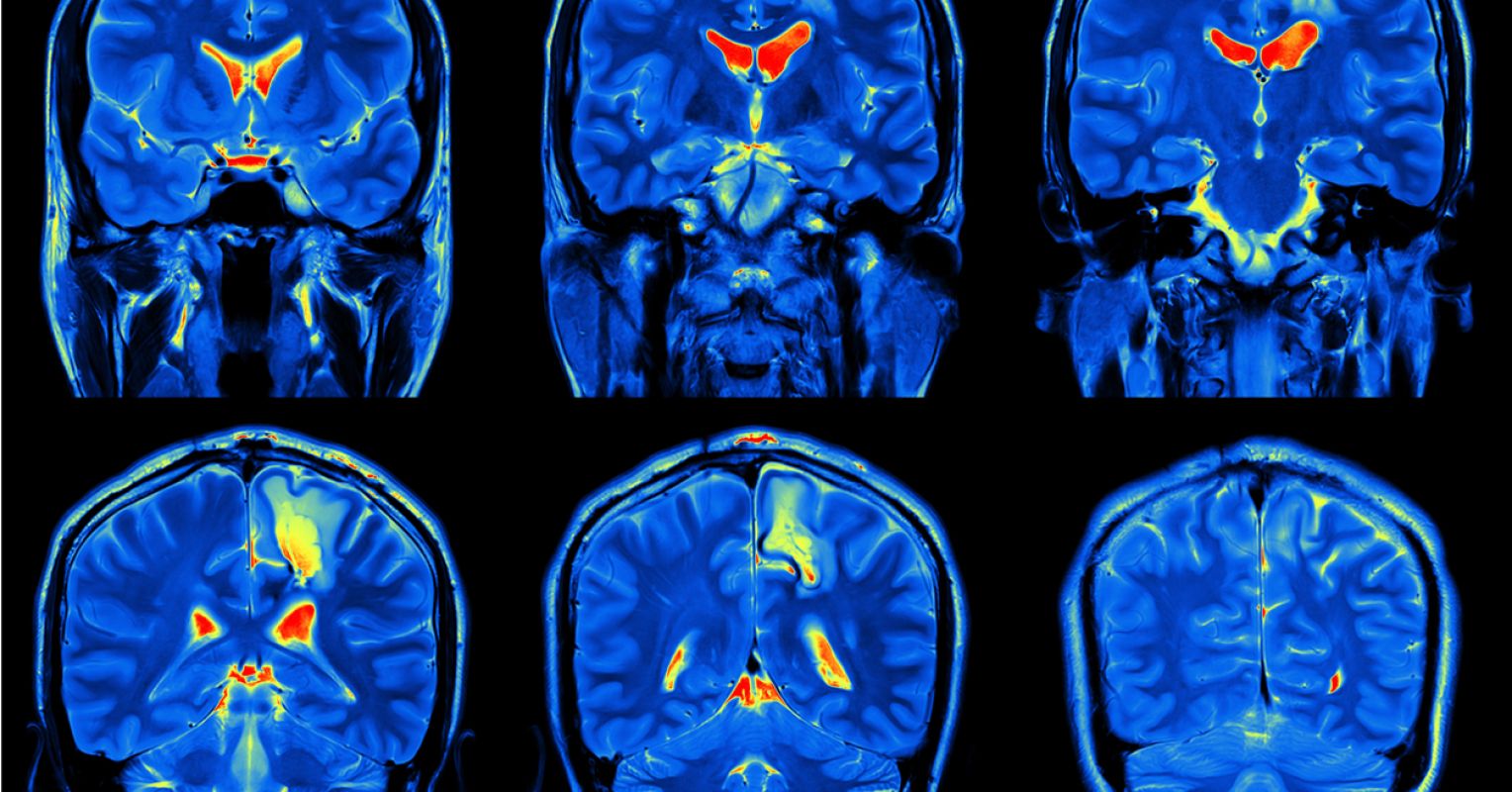 Do You Have an Average Brain? Its Unlikely. | Psychology Today