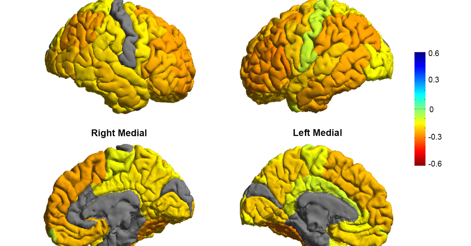 New MRI Study Leads to Roadmap of Bipolar Brains | Psychology Today