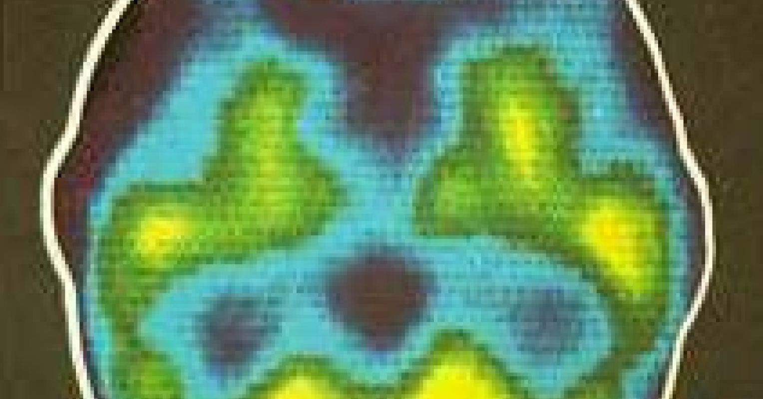 Using Brainwaves to Detect ADHD: What’s the Science Say? | Psychology Today