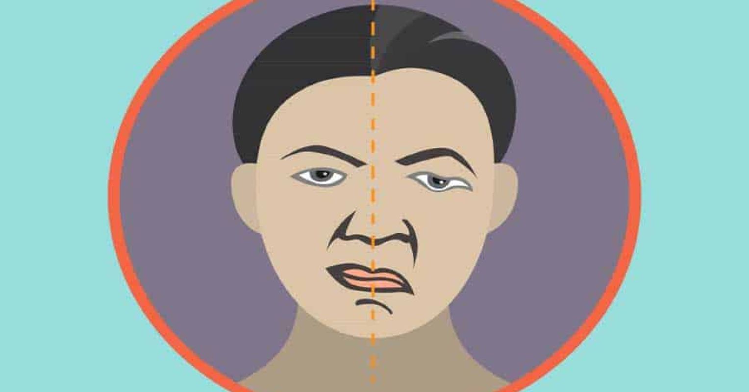 Bell’s Palsy and Mental Health | Psychology Today