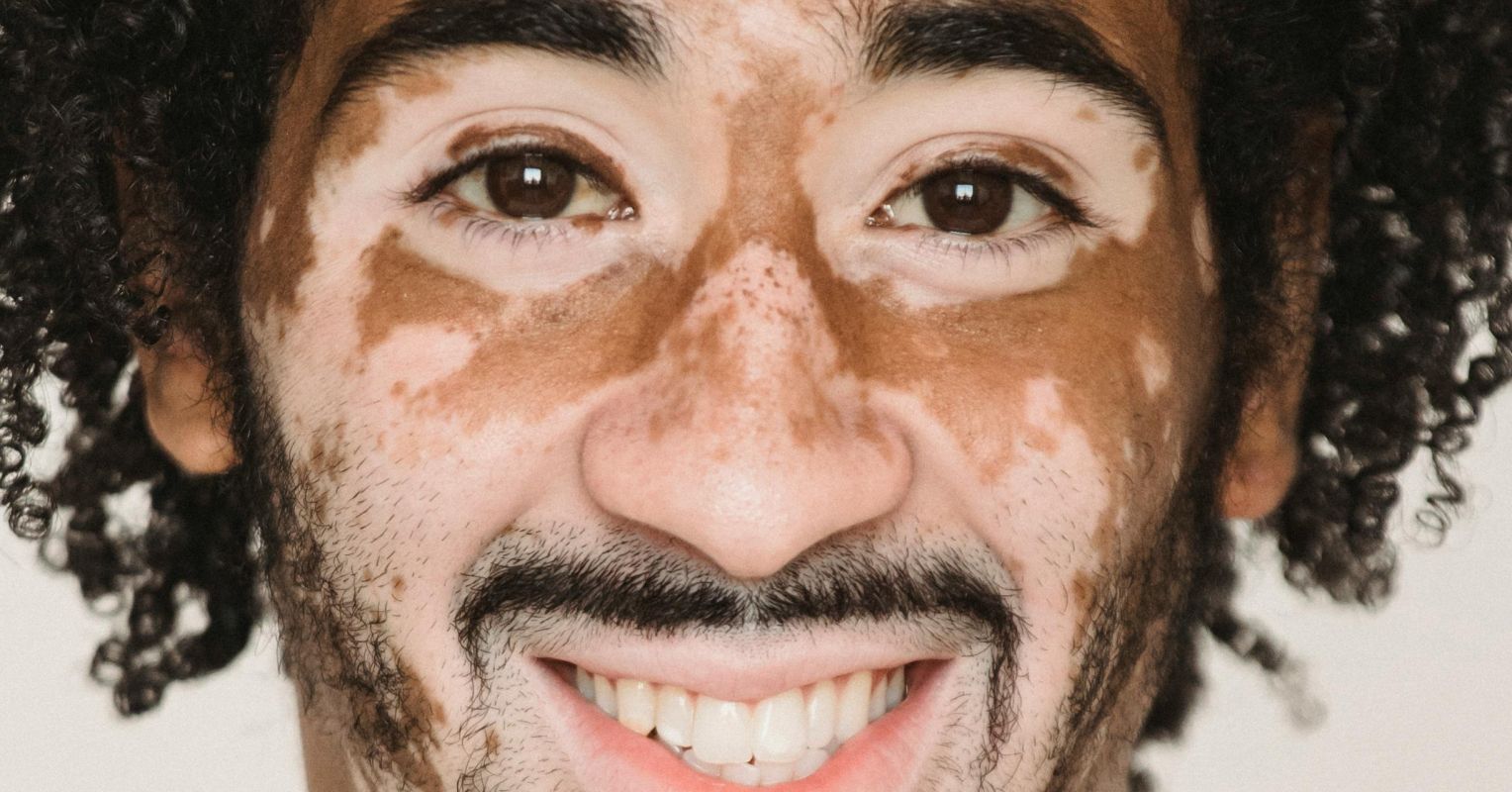 Improving Body Image Among People With a Visible Difference ...