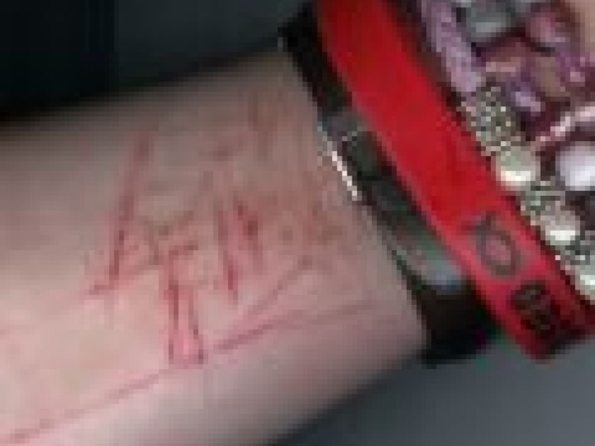self harm scars on arm
