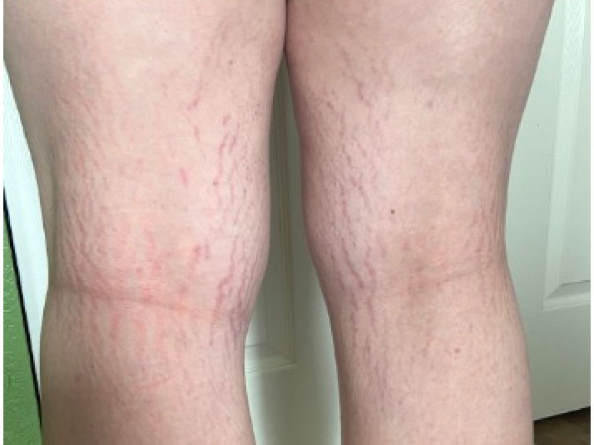 anorexia skin changes